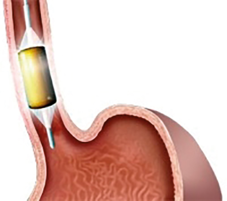 Tratamientos para el esófago de barret - Asociación de enfermos de ...
